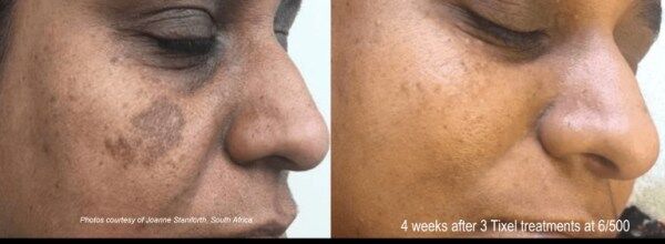 Tixel Non Invasive Skin Rejuvenation Anewskin Aesthetic Clinic And