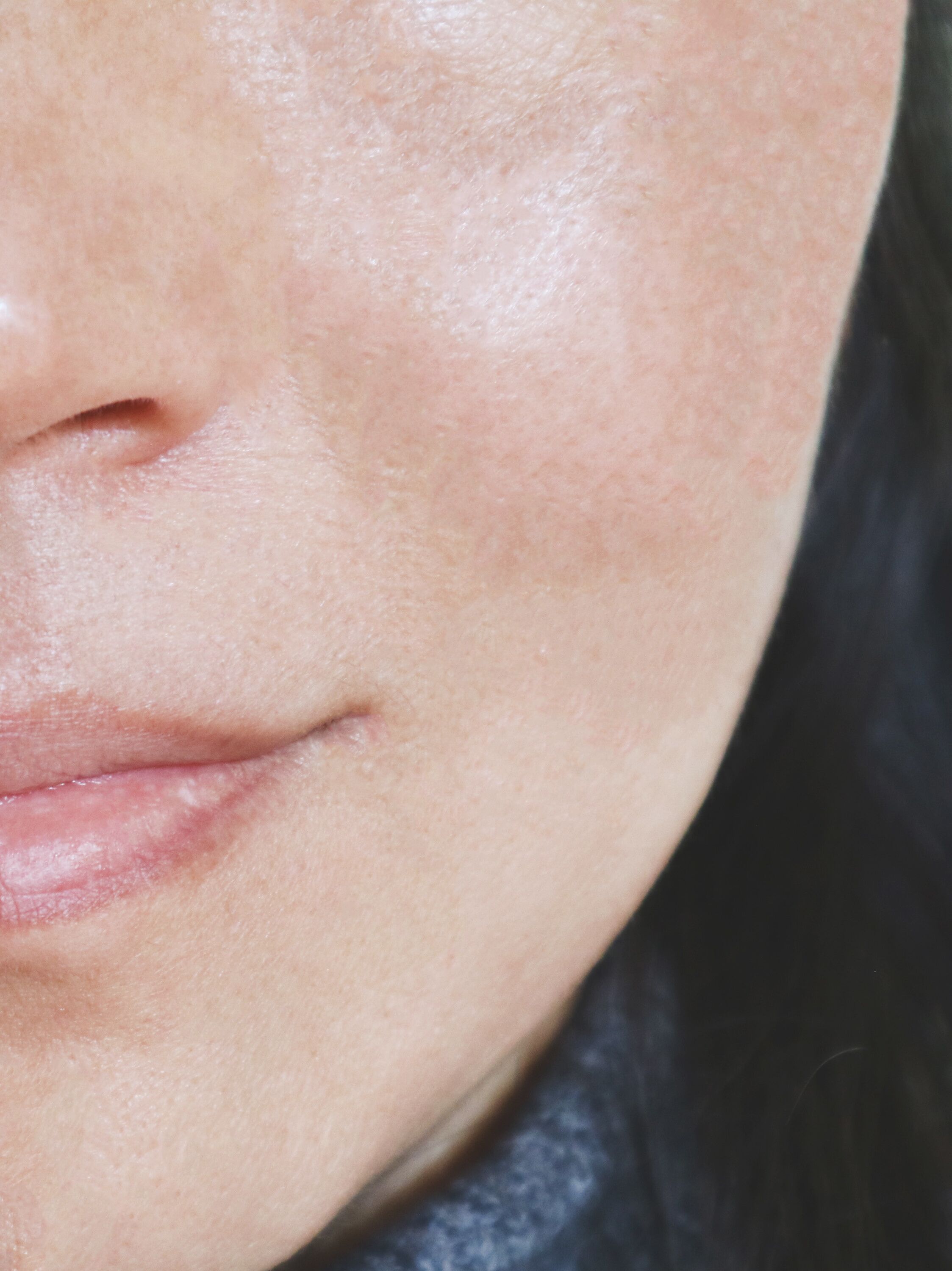 Chemical Peel Gallery Anewskin Aesthetic Clinic And Medical Spa