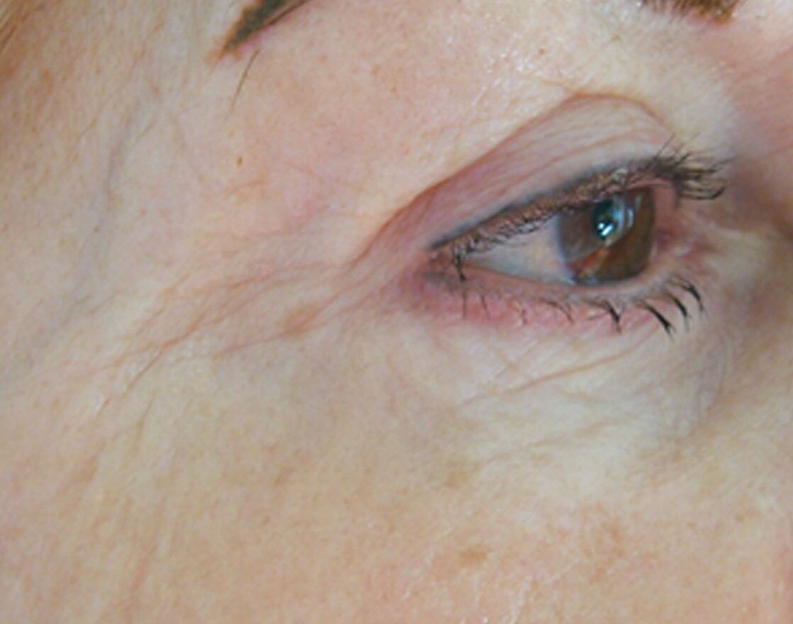 Lightwave Led Gallery Anewskin Aesthetic Clinic And Medical Spa