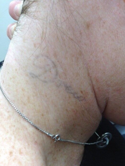 Tattoo Removal Gallery Anewskin Aesthetic Clinic And Medical Spa